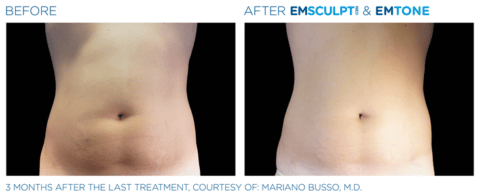 X-(Old)-Emsculpt NEO Before and After Pictures - Shape Med Centers