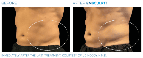 Love Handles Emsculpt NEO treatment at Shape Med Centers