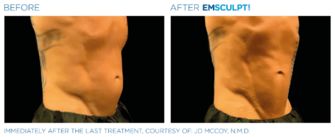 Love Handles Emsculpt NEO treatment at Shape Med Centers