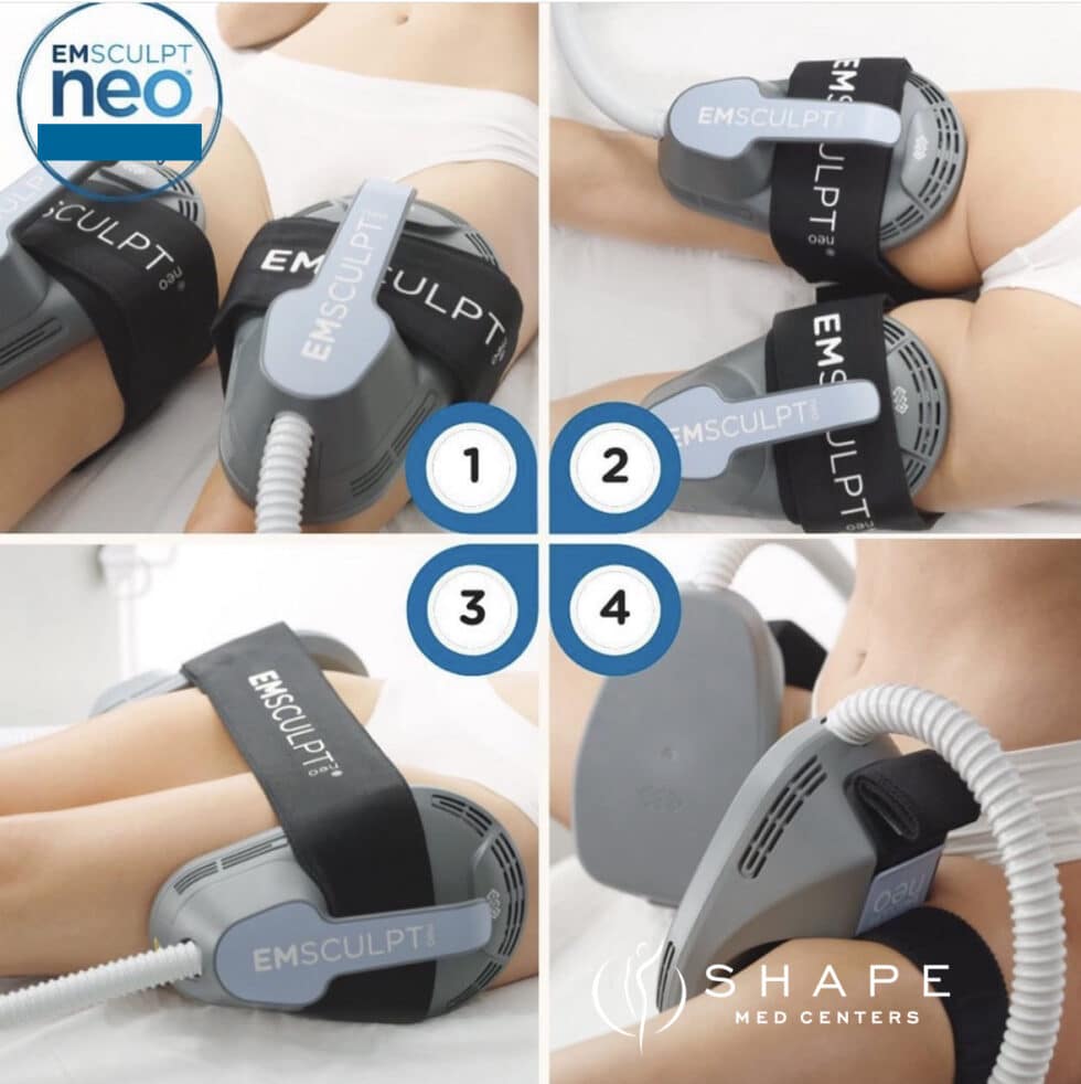 Thigh Emsculpt NEO treatment at Shape Med Centers
