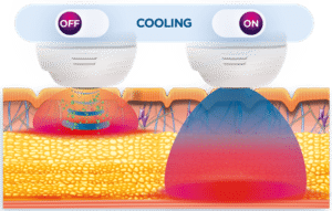 EXION Body Treatments at Shape Med Centers Charlotte