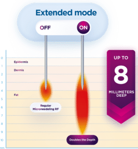 EXION RF Microneedling with AI | Shape Med Centers