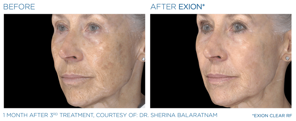 EXION Clear RF at Shape Med Centers in Charlotte