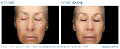 EXION Clear RF at Shape Med Centers in Charlotte