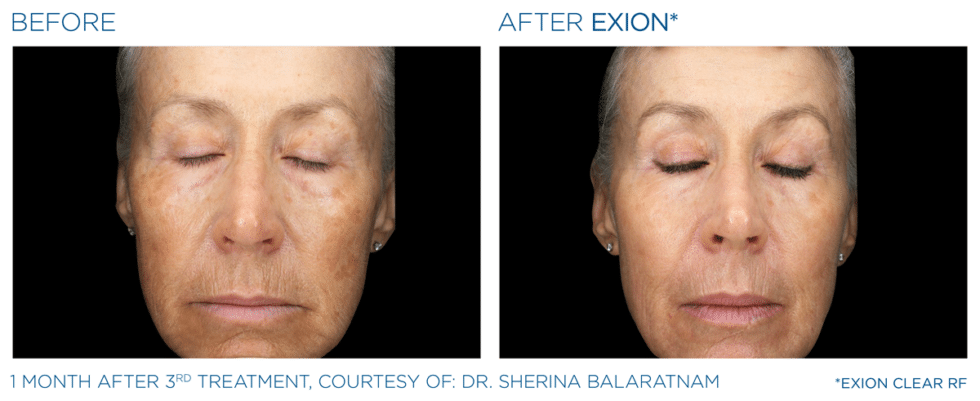 EXION Clear RF at Shape Med Centers in Charlotte