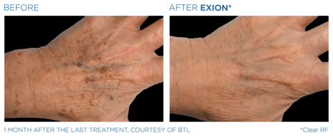 EXION Clear RF at Shape Med Centers in Charlotte